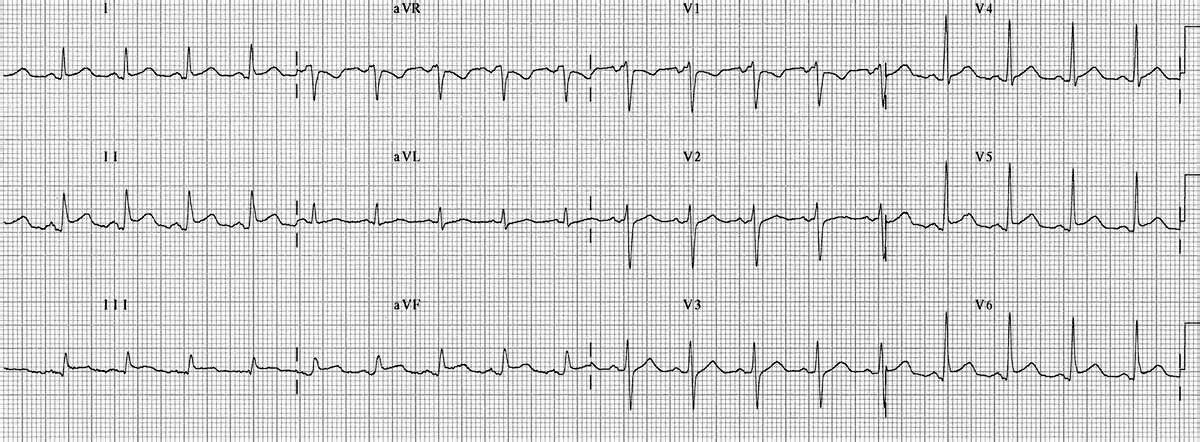 Pericarditis :Inflammation of the pericardium produces characteristic ...